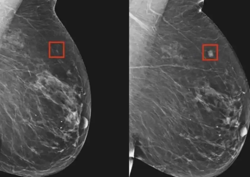 Mit Researchers Develop Ai Model For Early Breast Ainave